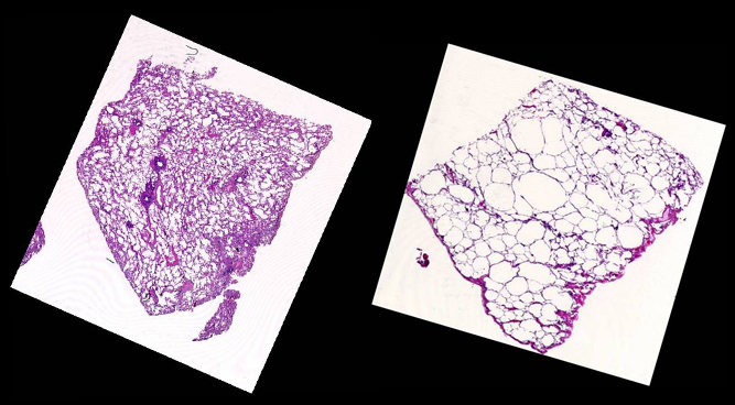 Lungan vill läka sig själv – Vetenskap och Hälsa