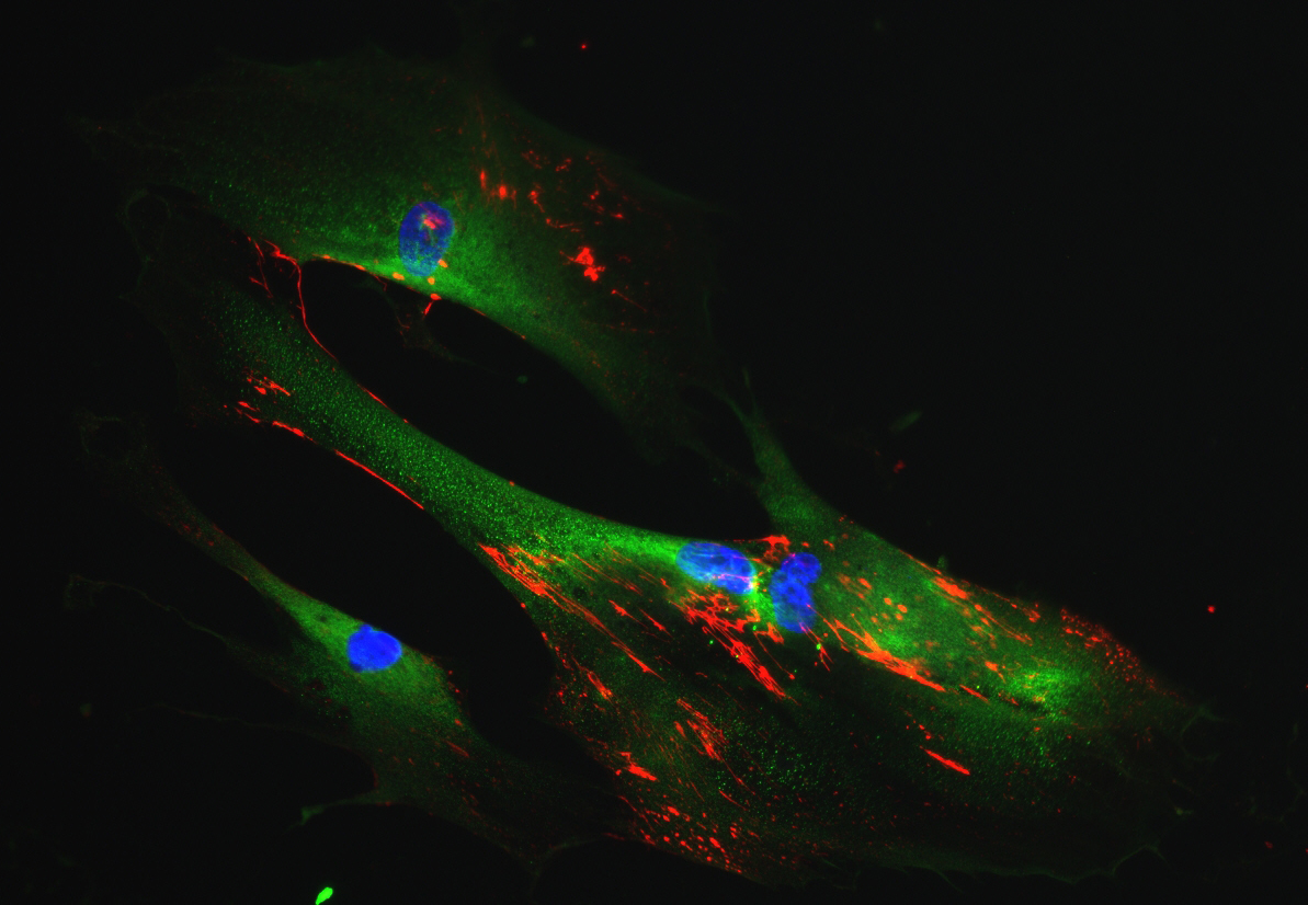 Bindväven förändras vid KOL – Vetenskap och Hälsa