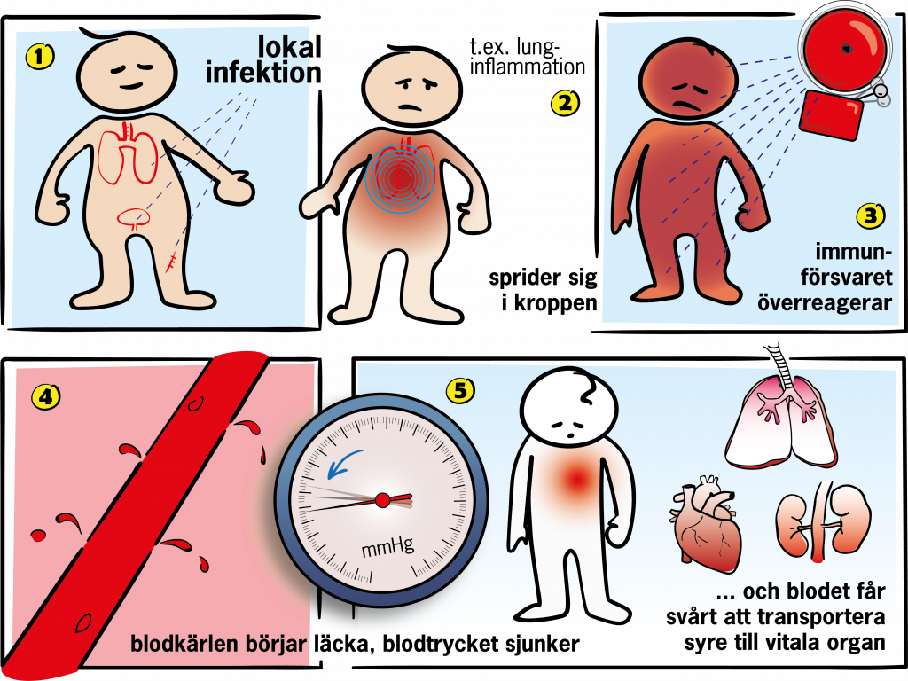 Vad är sepsis? – Vetenskap och Hälsa