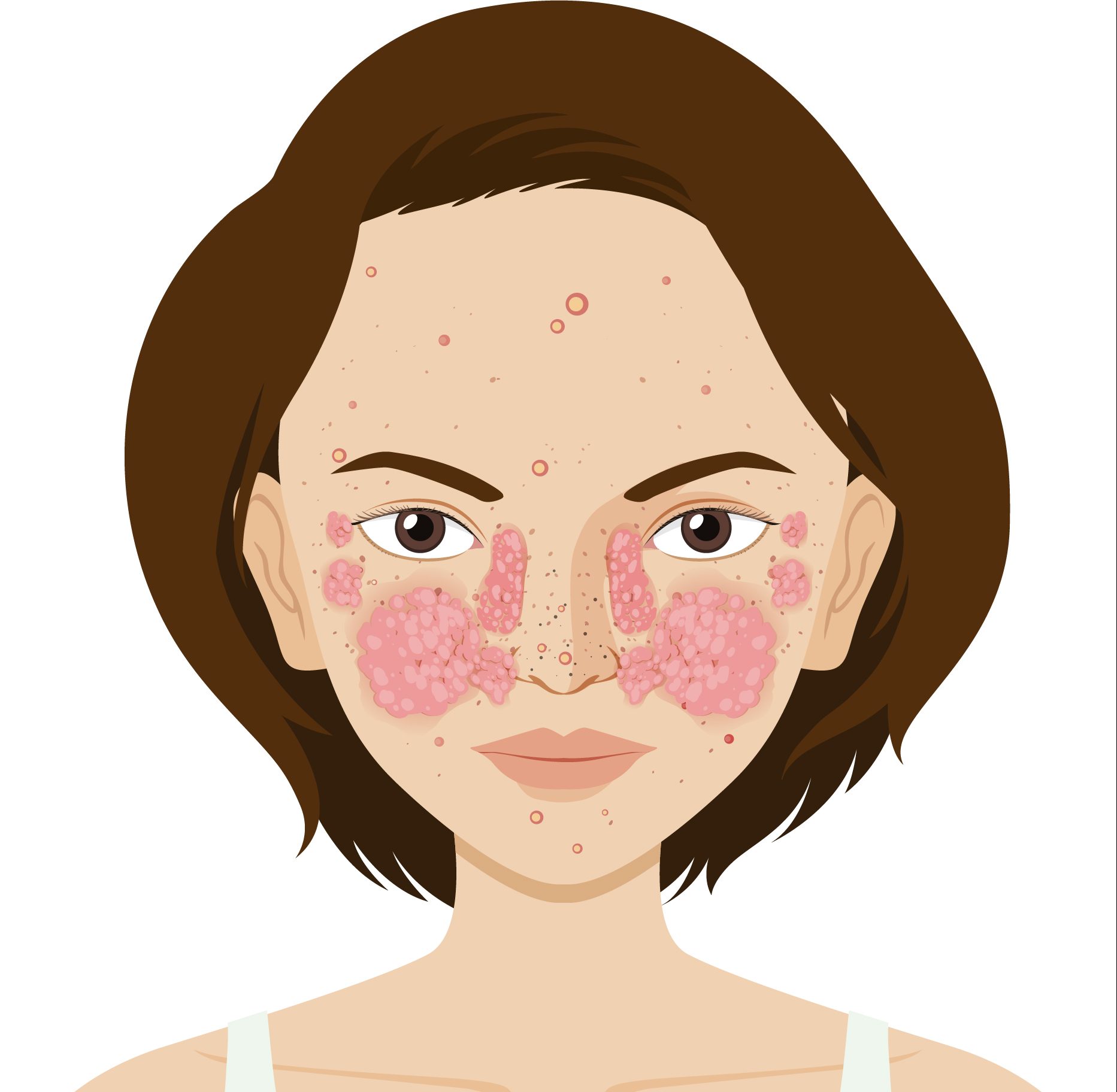 Nya behandlingar mot svår SLE ger hopp – Vetenskap och Hälsa